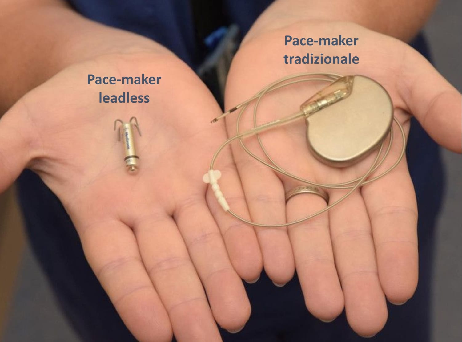 La cardiologia di Crotone guarda al futuro con i nuovi pacemaker leadless